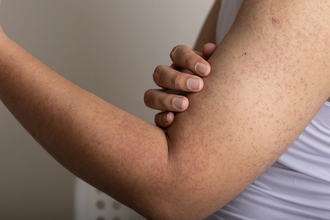 KERATOSIS PILARIS: HOW TO TREAT AND SMOOTH BUMPY SKIN – North Metro ...