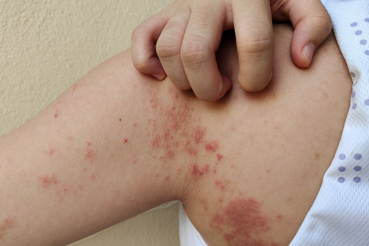 IMPETIGO TO GO: FAST FACTS ABOUT A CONTAGIOUS CONDITION – North Metro ...