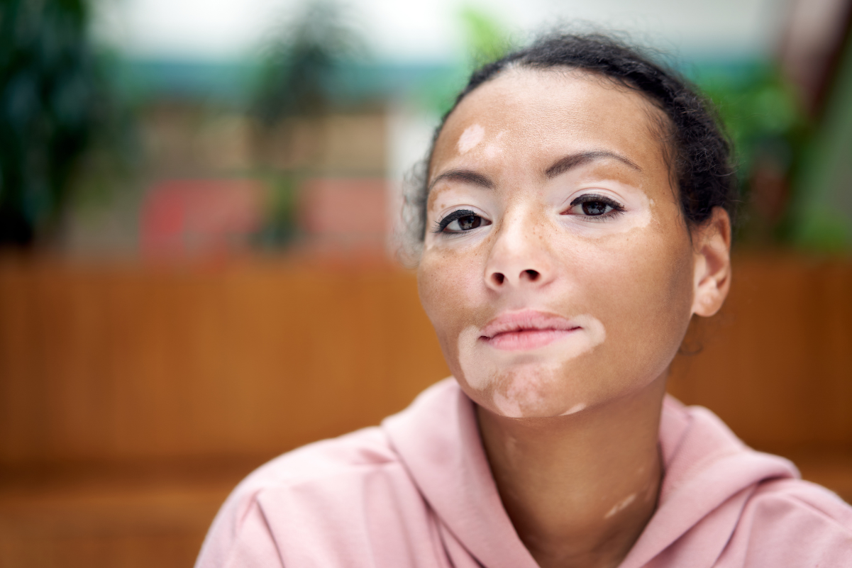 7 FACTS ABOUT VITILIGO: UNDERSTANDING THE CONDITION AND TREATMENT OPTI ...